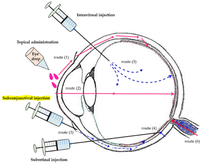 Subconjunctival Injection